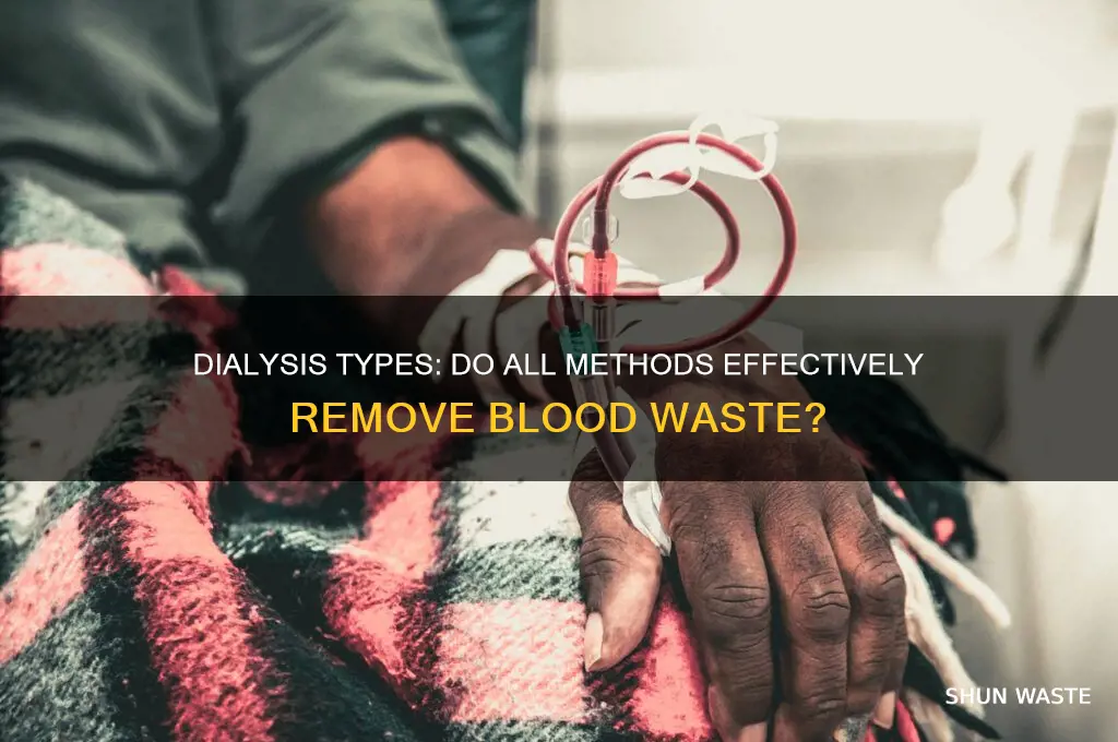Dialysis Types: Do All Methods Effectively Remove Blood Waste? | ShunWaste