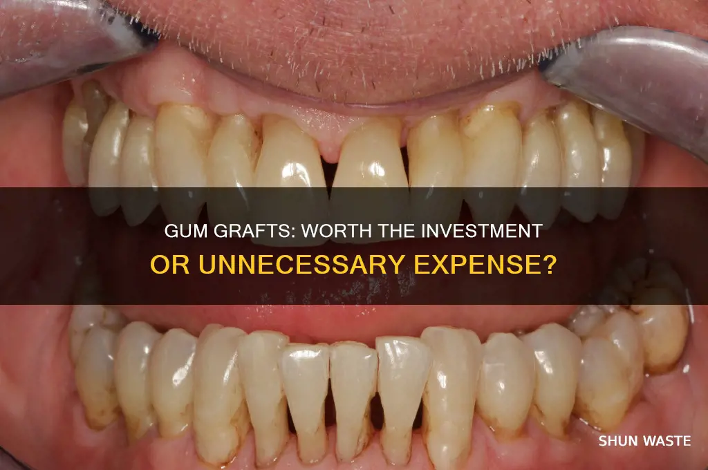 Gum Grafts: Worth The Investment Or Unnecessary Expense? | ShunWaste