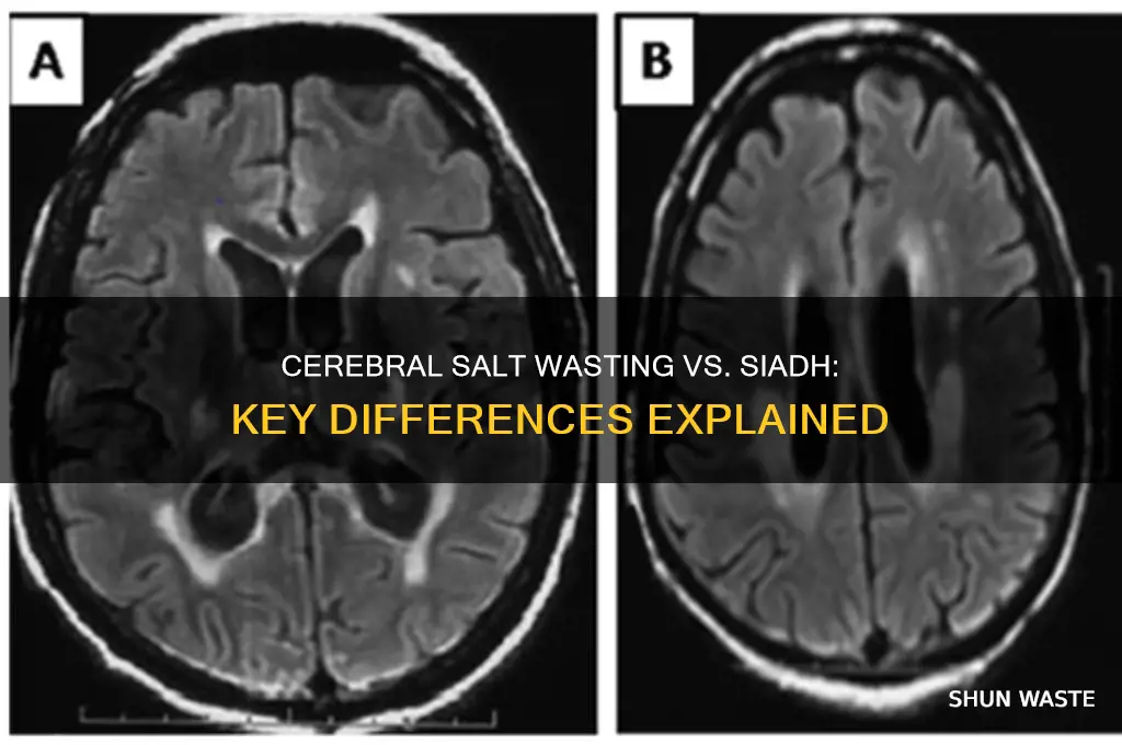 Cerebral Salt Wasting Vs. Siadh: Key Differences Explained | ShunWaste